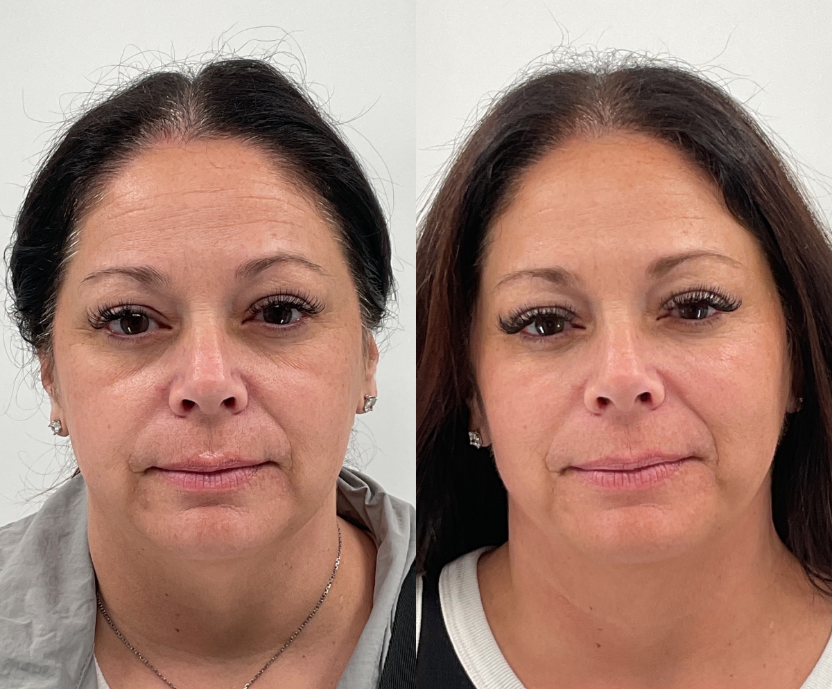 Skinvive Before and After in Addison, TX - Star Rejuvenation