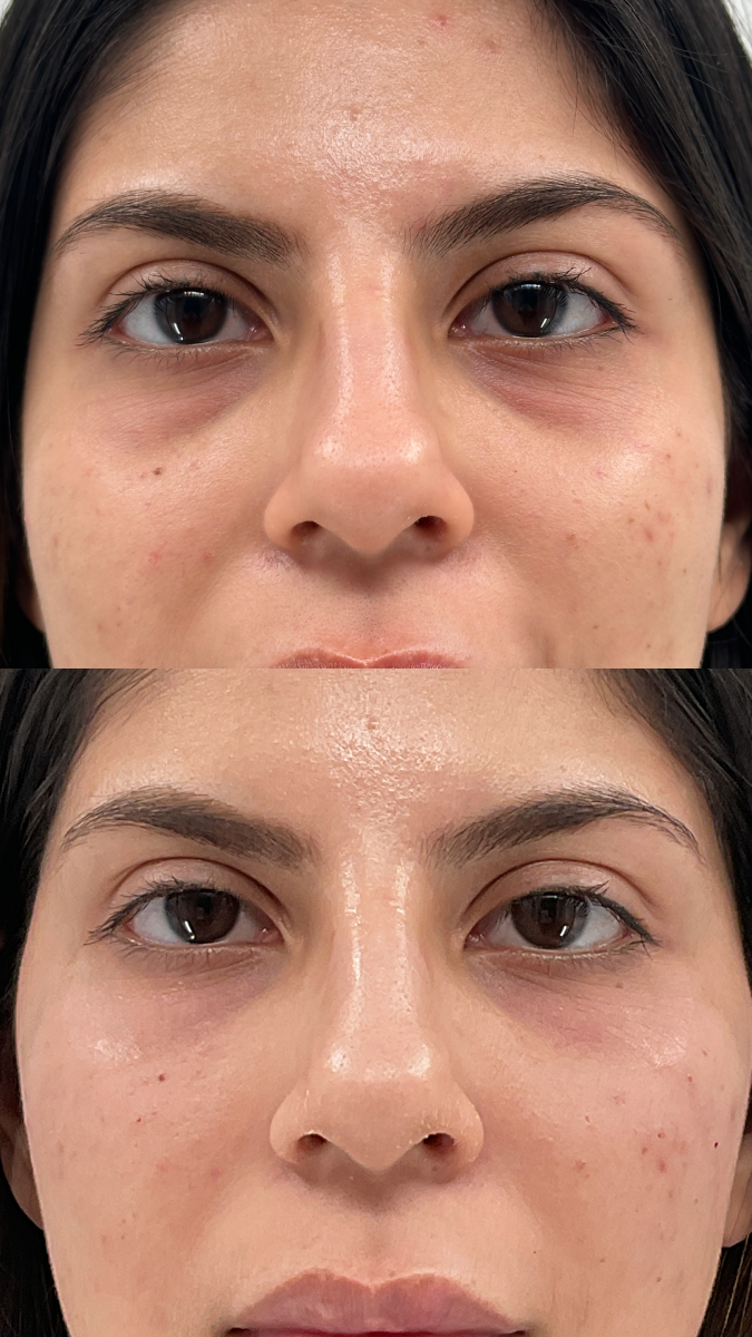 Tear Trough Correction Results in Addison, TX | Star Rejuvenation